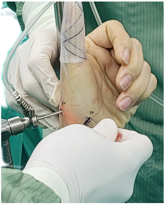 Arthroscopic Partial Trapeziectomy and Free Tendon Suspension and ...