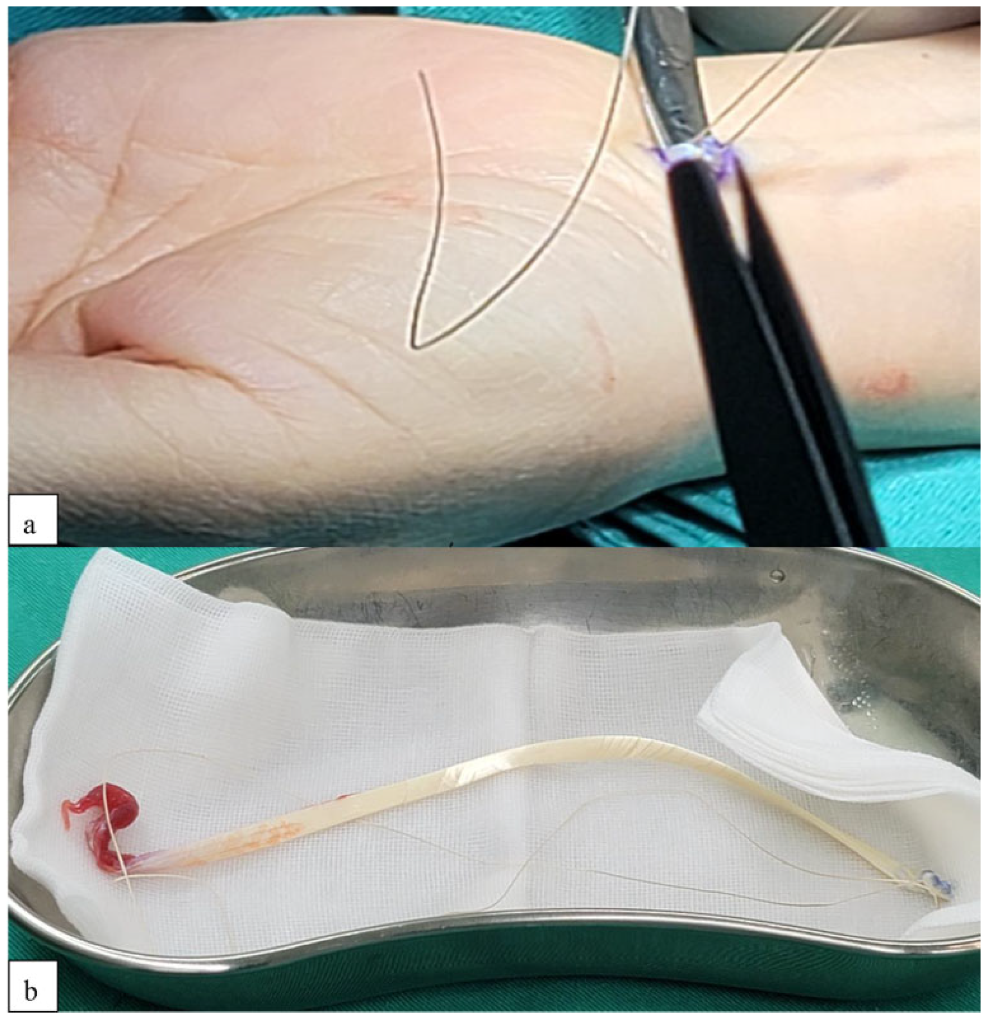 Arthroscopic Partial Trapeziectomy and Free Tendon Suspension and ...