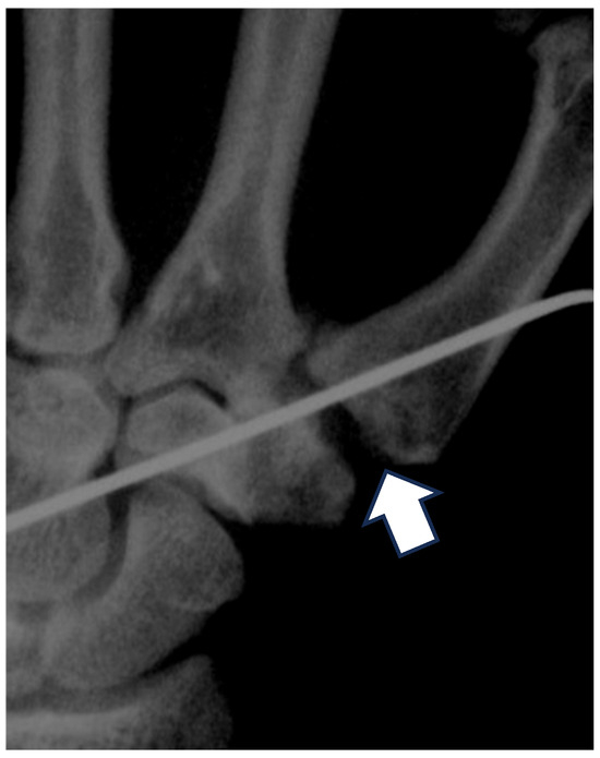 Arthroscopic Partial Trapeziectomy and Free Tendon Suspension and ...