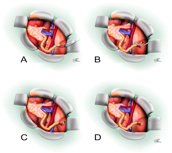 Ureteric Complications and Urinary Tract Reconstruction Techniques in ...