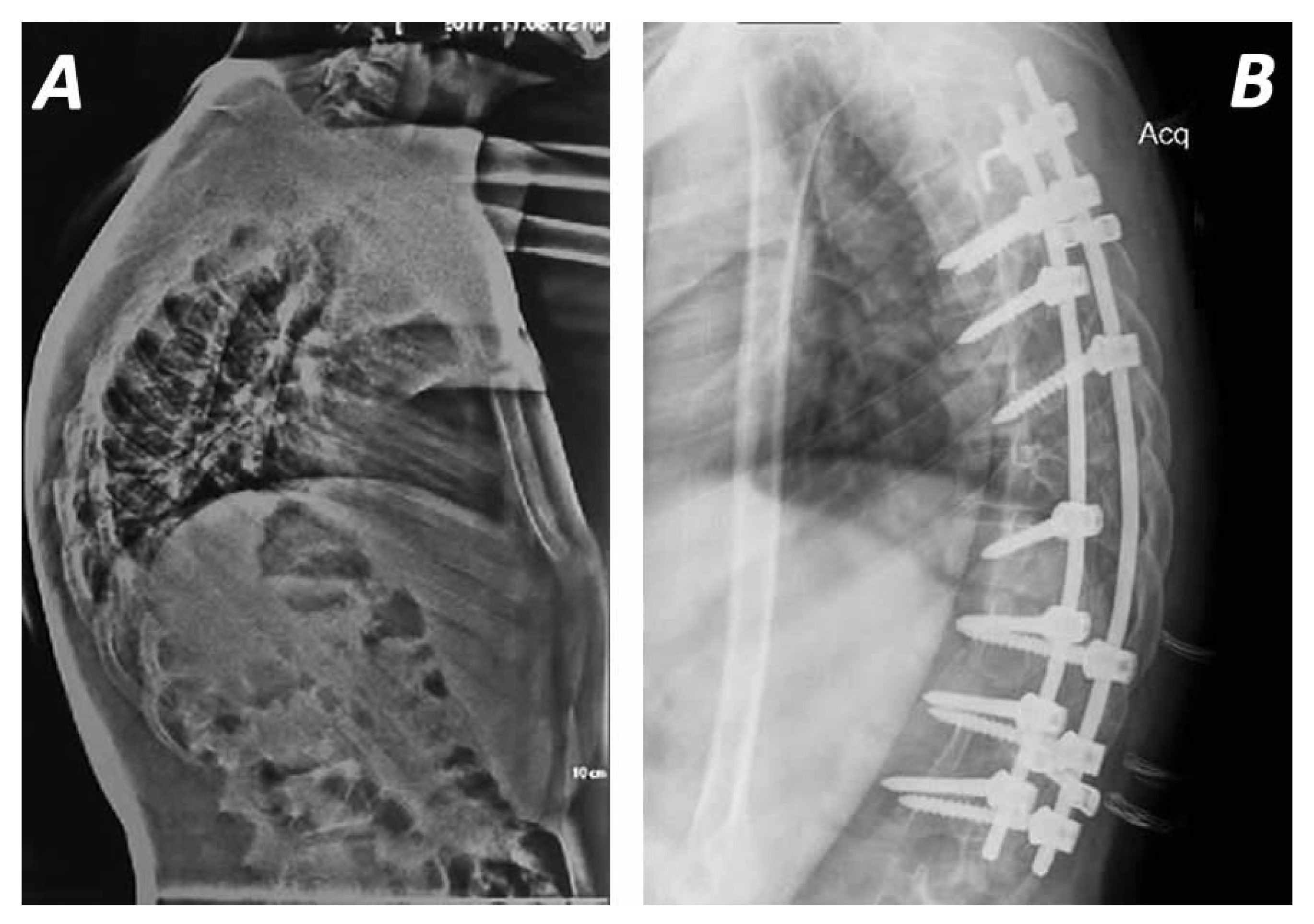 Surgical Strategies and Challenges in Scheuermann’s Kyphosis: A ...