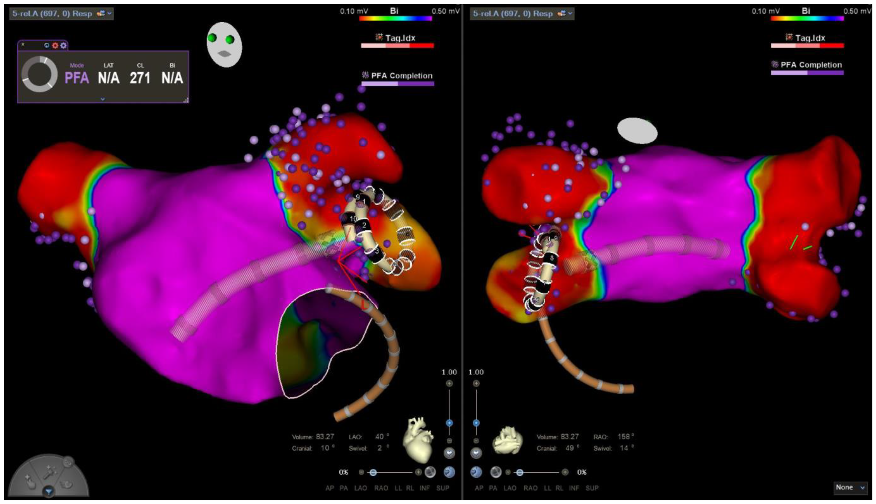 How to: Streamlining Pulsed Field Ablation-Based Pulmonary Vein Isolation Using 3D Mapping ...