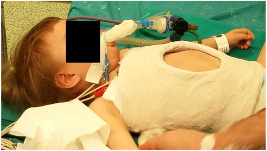 Serial Casting for Early-Onset Scoliosis