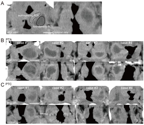 Accurate Diagnosis of Peritonsillar Abscesses Using Relative CT Number ...