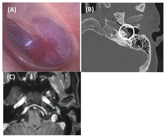 Pulsatile Tinnitus: A Comprehensive Clinical Approach to Diagnosis and ...