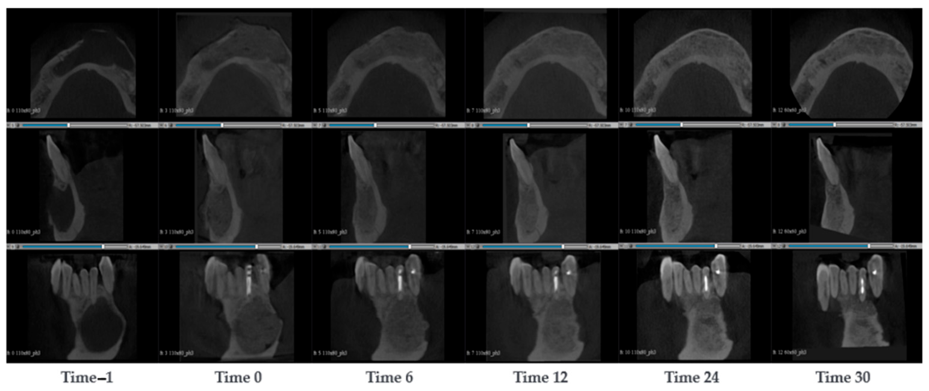 Bone Selective Remodeling of Xeno-Hybrid Grafts: A Case Series