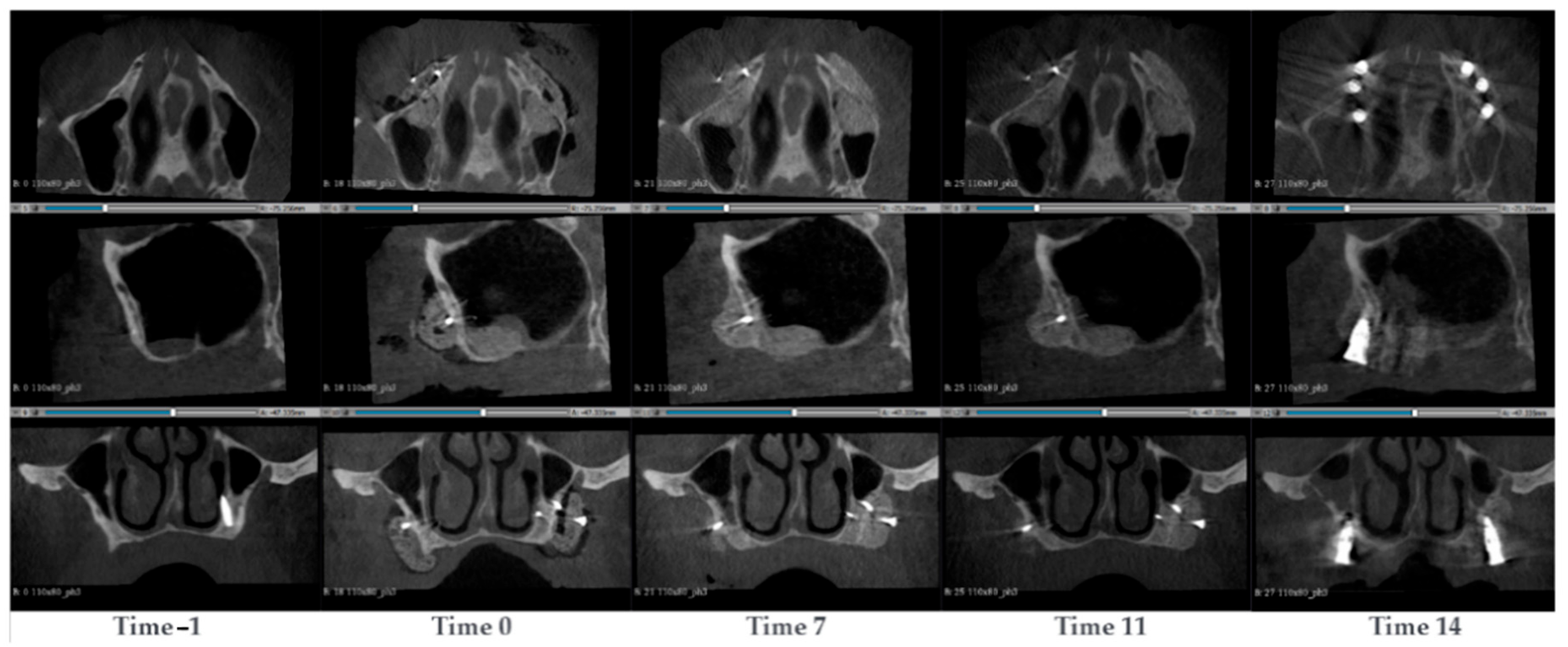 Bone Selective Remodeling of Xeno-Hybrid Grafts: A Case Series