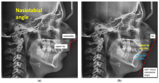 Innovative Aesthetic and Functional Orthodontic Planning with Hard and ...