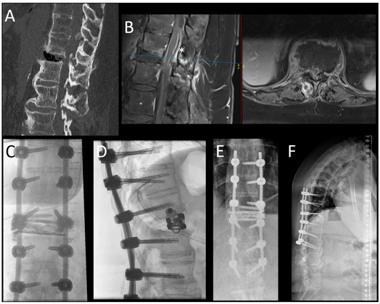 Minimally Invasive Lateral Thoracic and Lumbar Interbody Fusion with ...