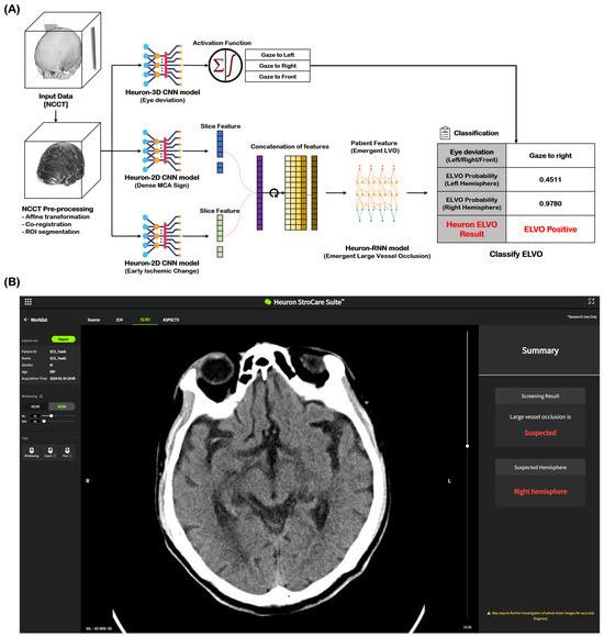 Using a Deep Learning-Based Decision Support System to Predict Emergent Large Vessel Occlusion ...