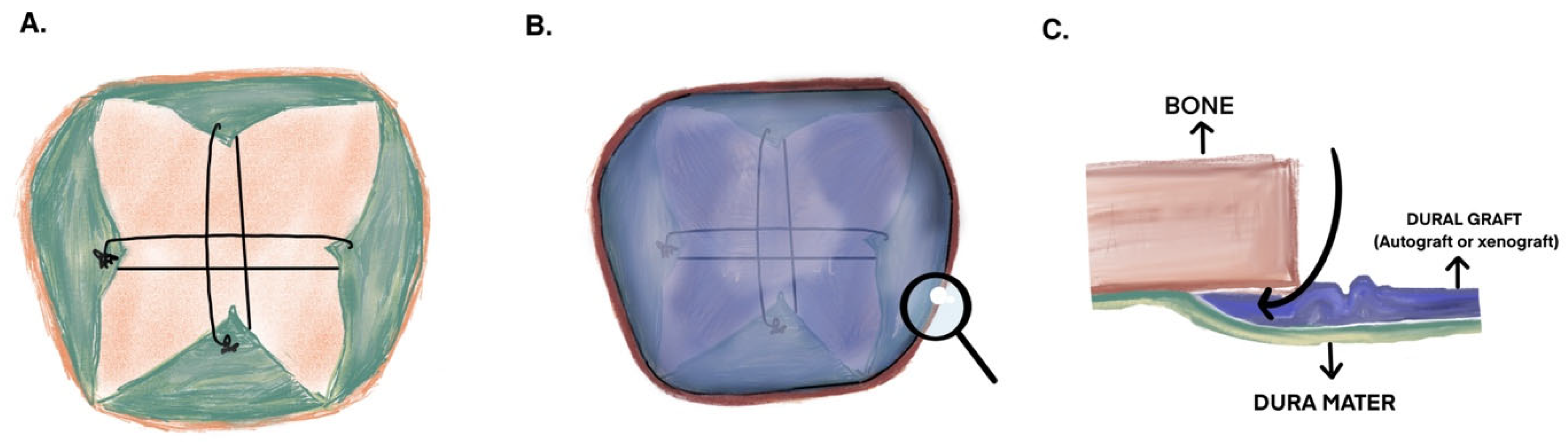 Autograft vs. Xenograft Duraplasty Using the Onlay Technique in ...