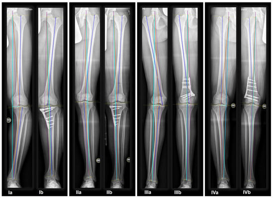Changes of Knee Phenotypes Following Osteotomy Around the Knee in ...