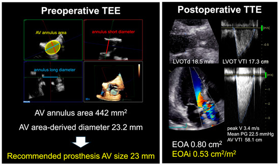 Three-Dimensional Transesophageal Echocardiography Is Useful for ...