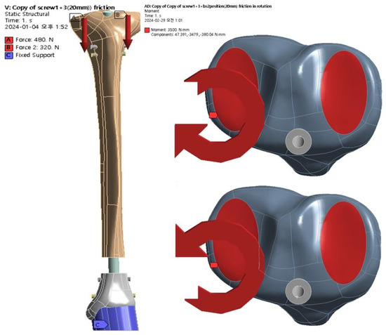 Stress Distribution in Interlocking and Blocking Screw Fixation for ...