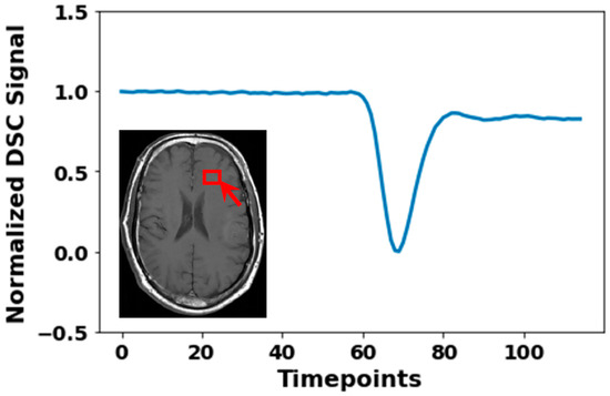 DSC Perfusion MRI Artefact Reduction Strategies: A Short Overview for ...