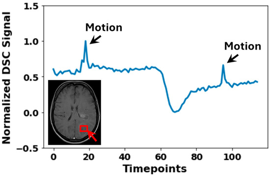 DSC Perfusion MRI Artefact Reduction Strategies: A Short Overview for ...