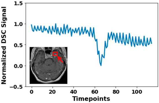 DSC Perfusion MRI Artefact Reduction Strategies: A Short Overview for ...