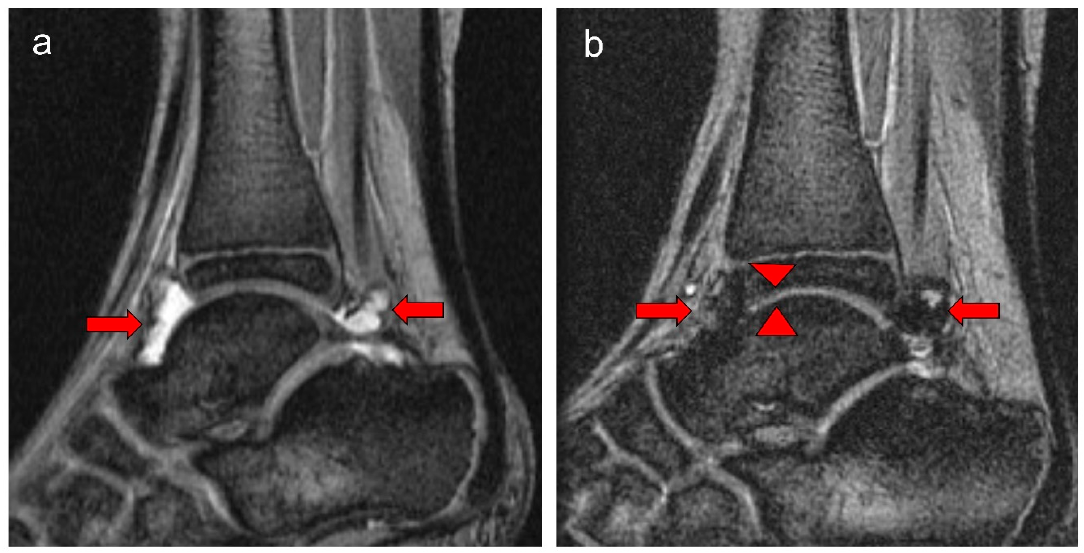 Comparison of Magnetic Resonance Imaging Scales for Assessment of ...