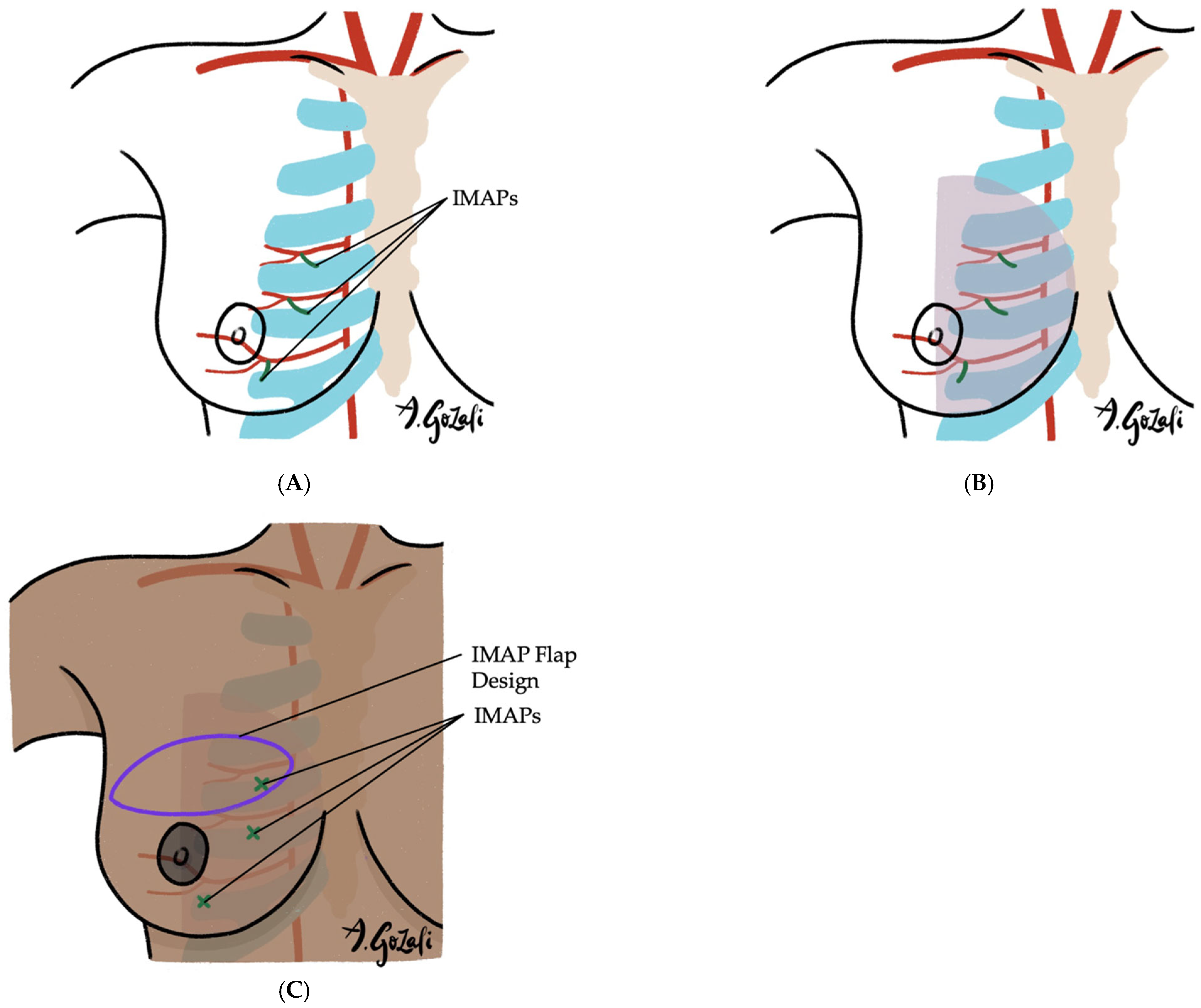 Optimizing Outcomes in Oncoplastic Breast-Conserving Surgery