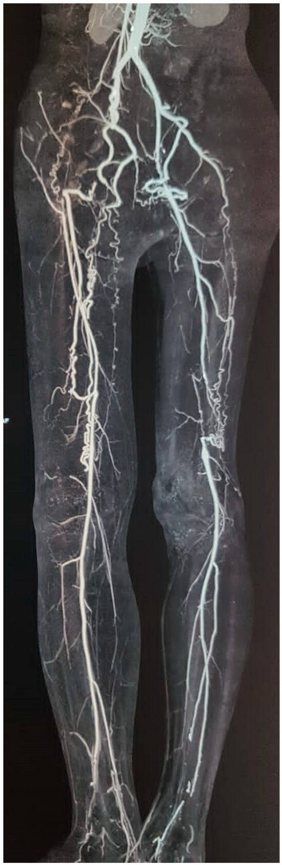 The Angiography Pattern of Buerger’s Disease: Challenges and ...