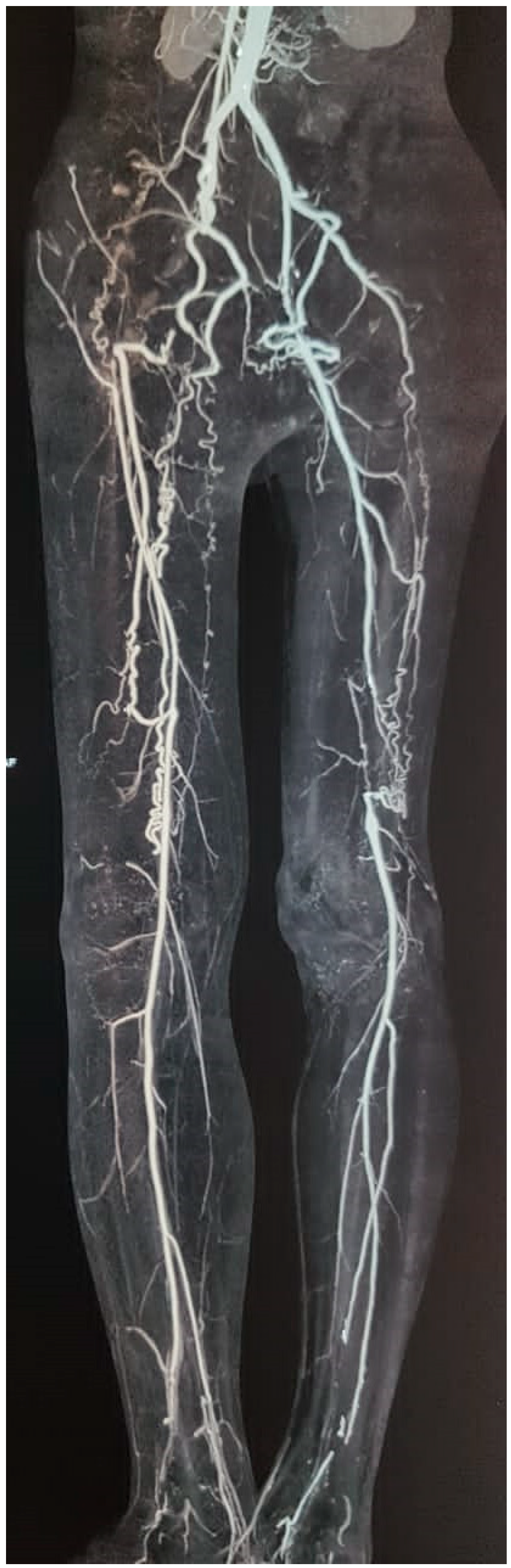 Buergers Angiogram Radiology Hand