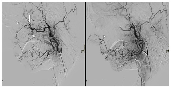 Superselective Unilateral Embolization of the Sphenopalatine Artery for ...