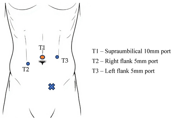 Modern Perspectives on Inguinal Hernia Repair: A Narrative Review on ...