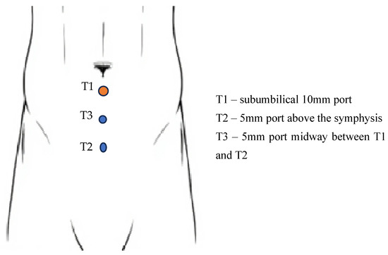 Modern Perspectives on Inguinal Hernia Repair: A Narrative Review on ...