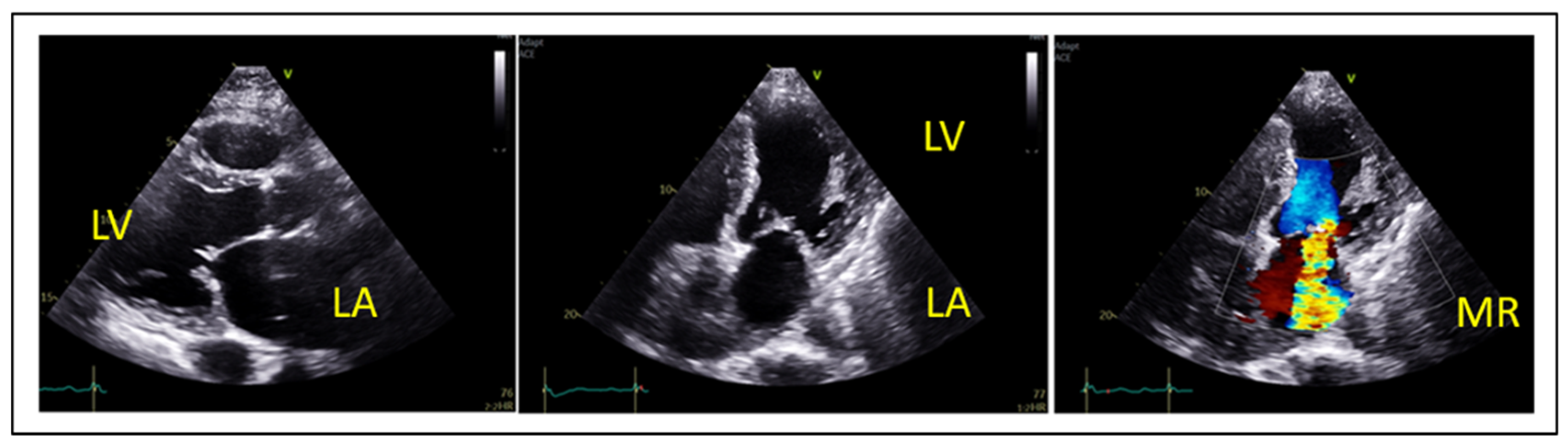 Screening and Procedural Guidance for Mitral Transcatheter Edge-to-Edge ...