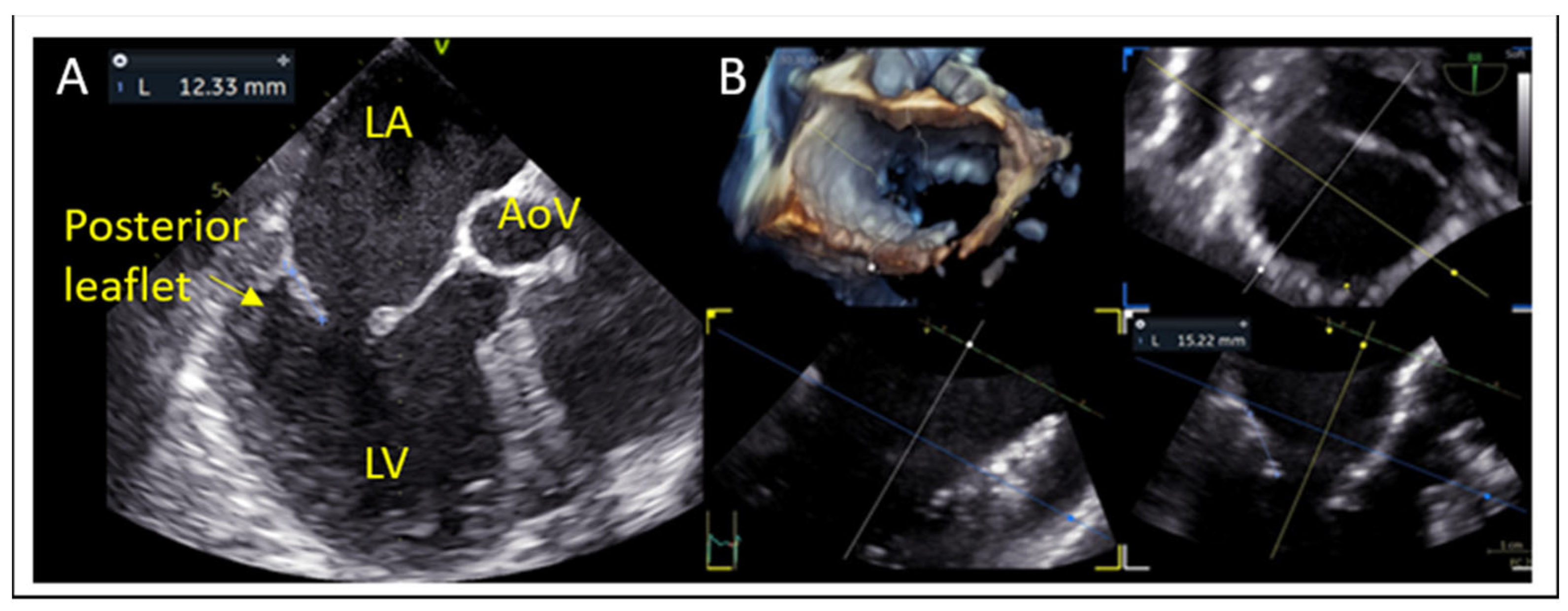 Screening and Procedural Guidance for Mitral Transcatheter Edge-to-Edge ...