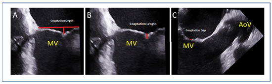 Screening and Procedural Guidance for Mitral Transcatheter Edge-to-Edge ...