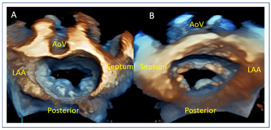 Screening and Procedural Guidance for Mitral Transcatheter Edge-to-Edge ...