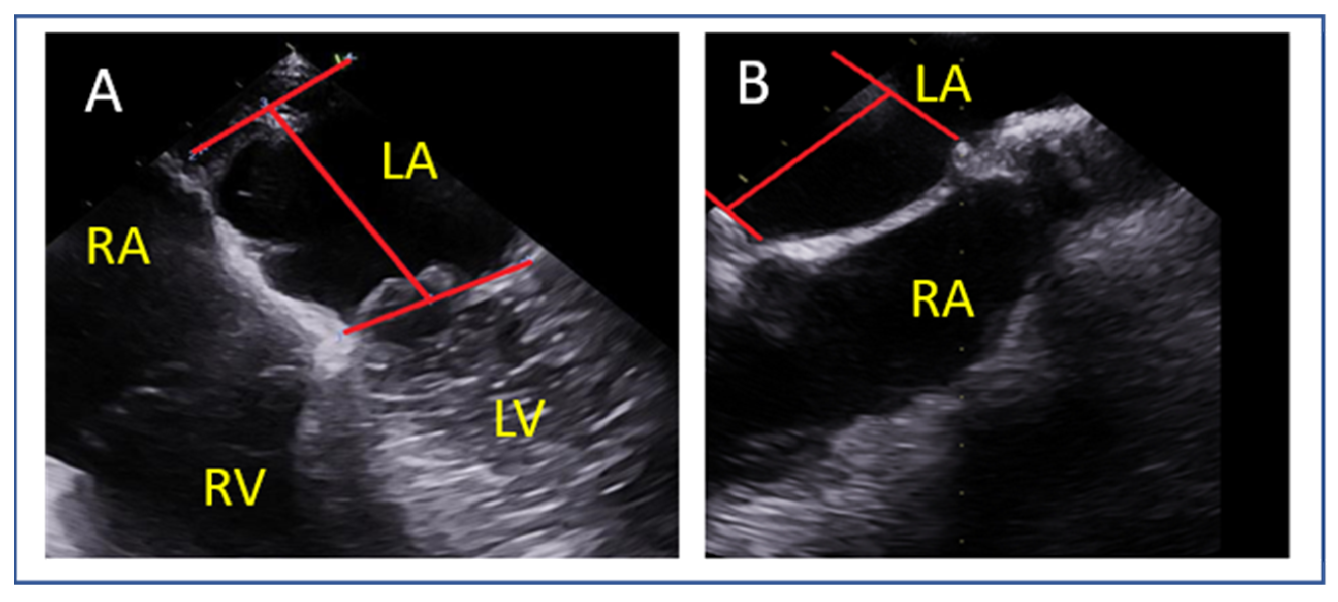 Screening and Procedural Guidance for Mitral Transcatheter Edge-to-Edge ...