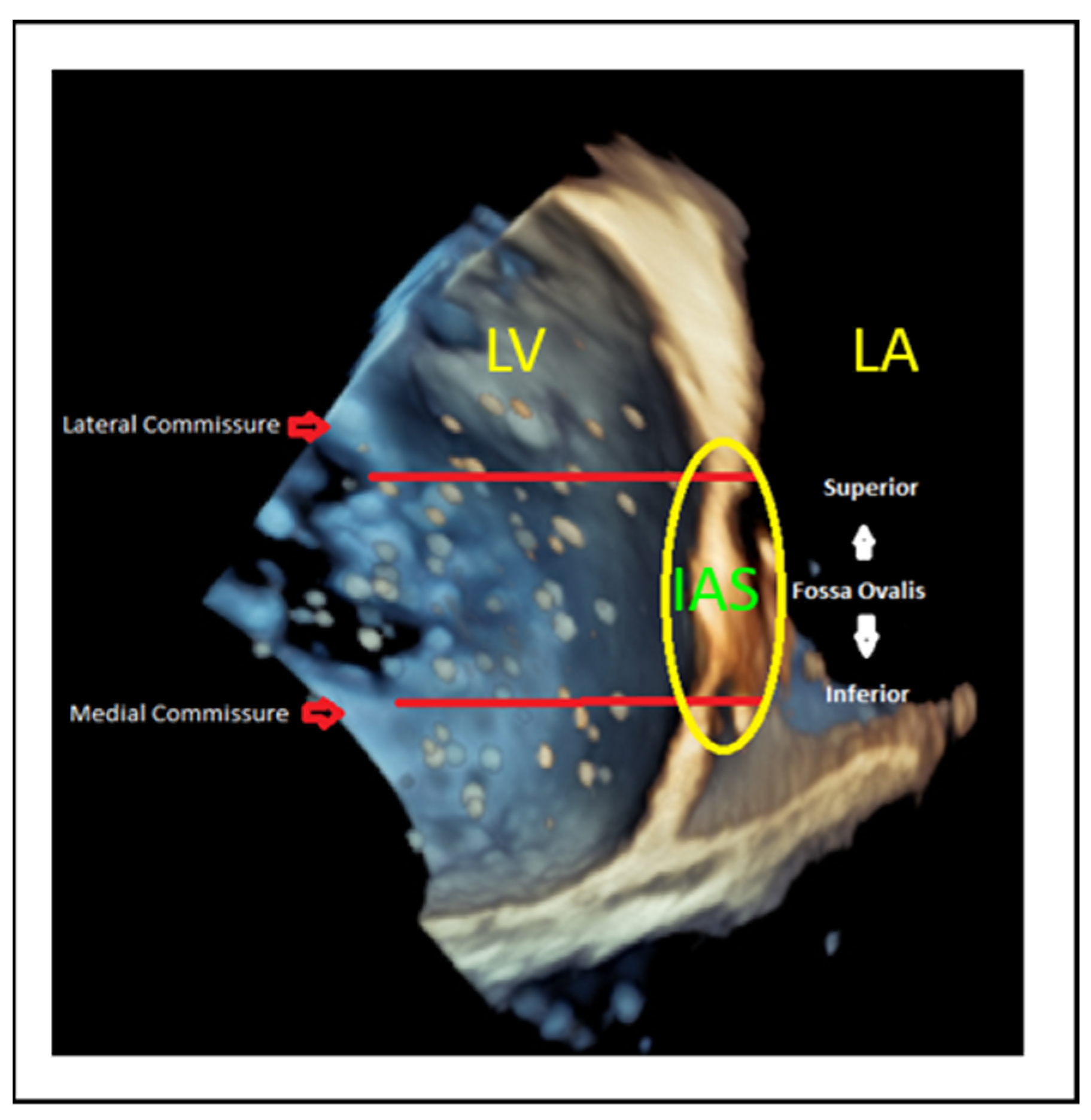 Screening and Procedural Guidance for Mitral Transcatheter Edge-to-Edge ...