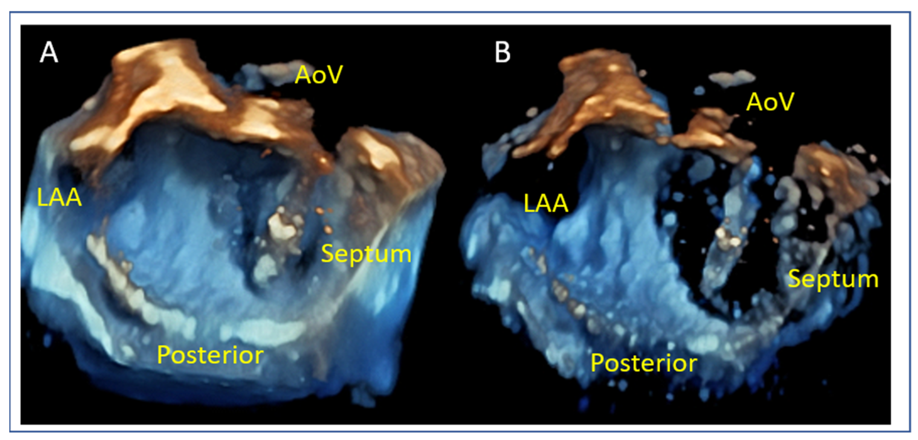 Screening and Procedural Guidance for Mitral Transcatheter Edge-to-Edge ...