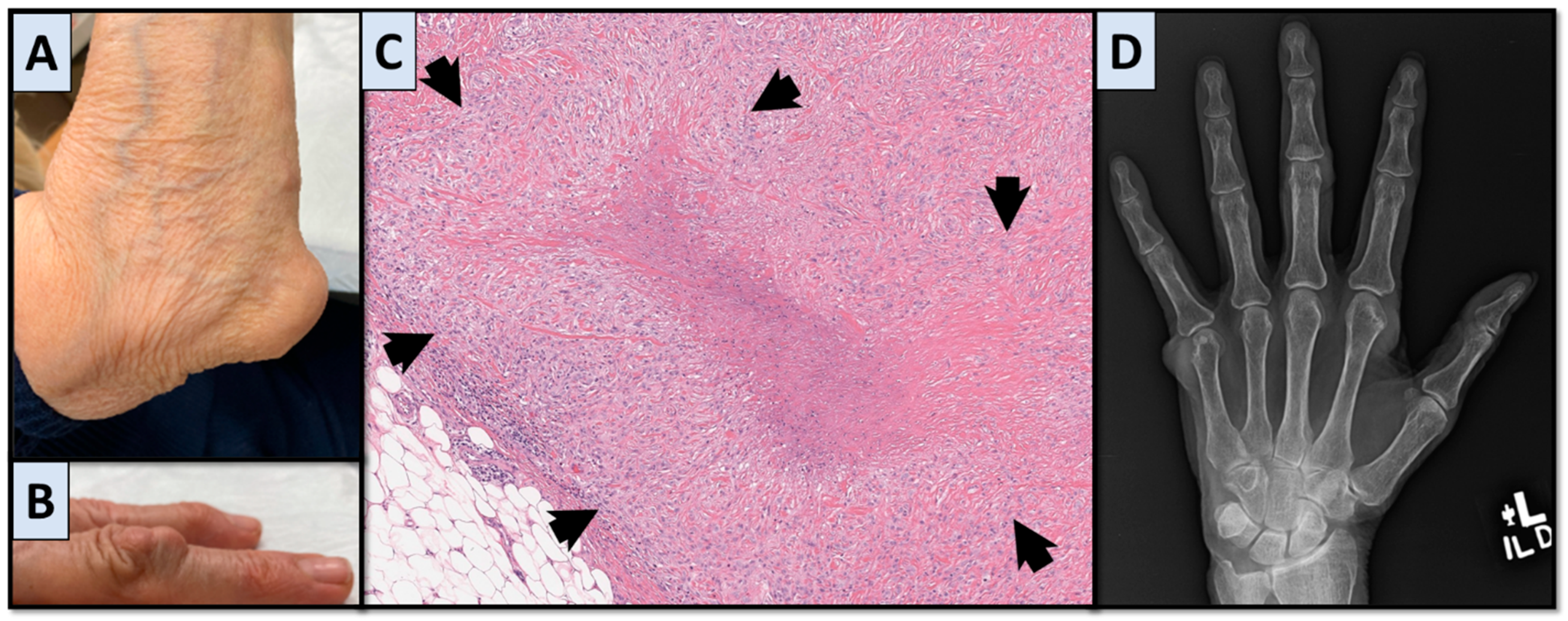 Cutaneous Nodules and Inflammatory Arthritis: Two Illustrative Cases of ...