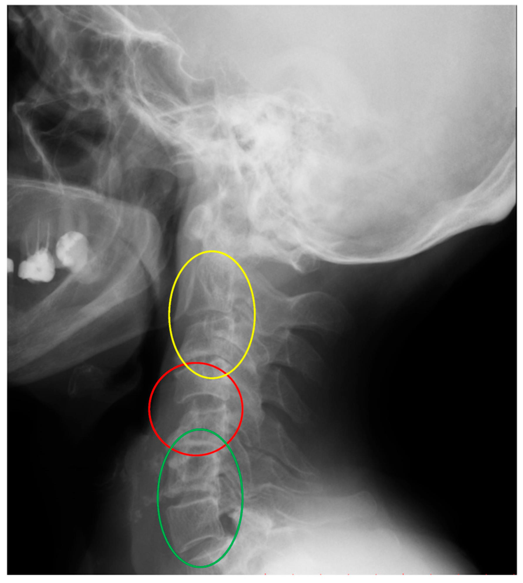 Subaxial Subluxation (SAS) and Cervical Deformity in Patients with ...