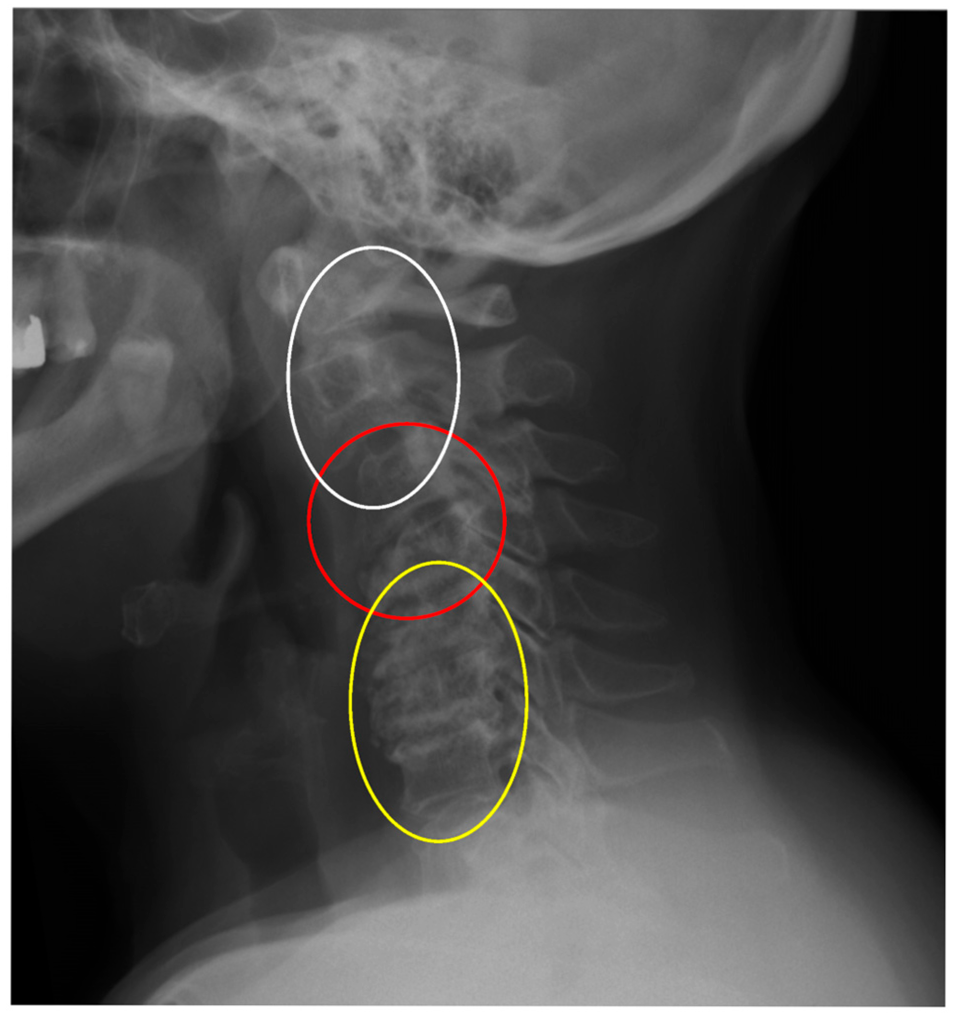Subaxial Subluxation (SAS) and Cervical Deformity in Patients with ...