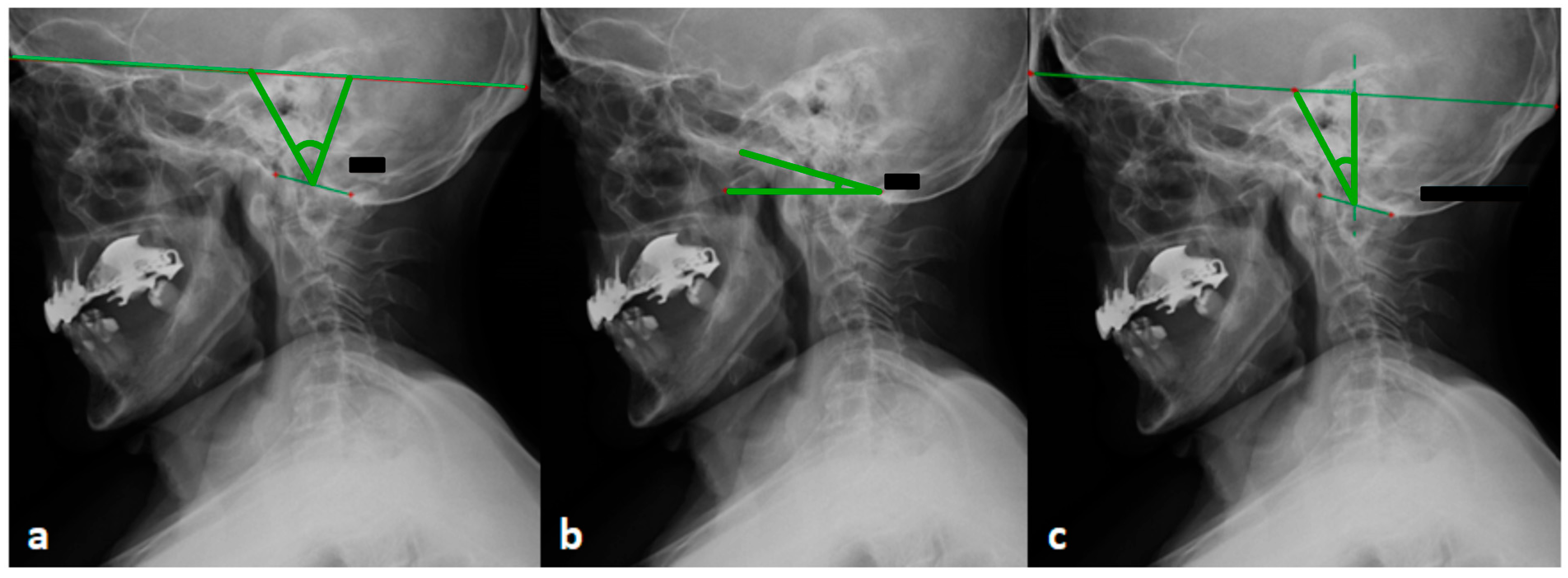 Subaxial Subluxation (SAS) and Cervical Deformity in Patients with ...