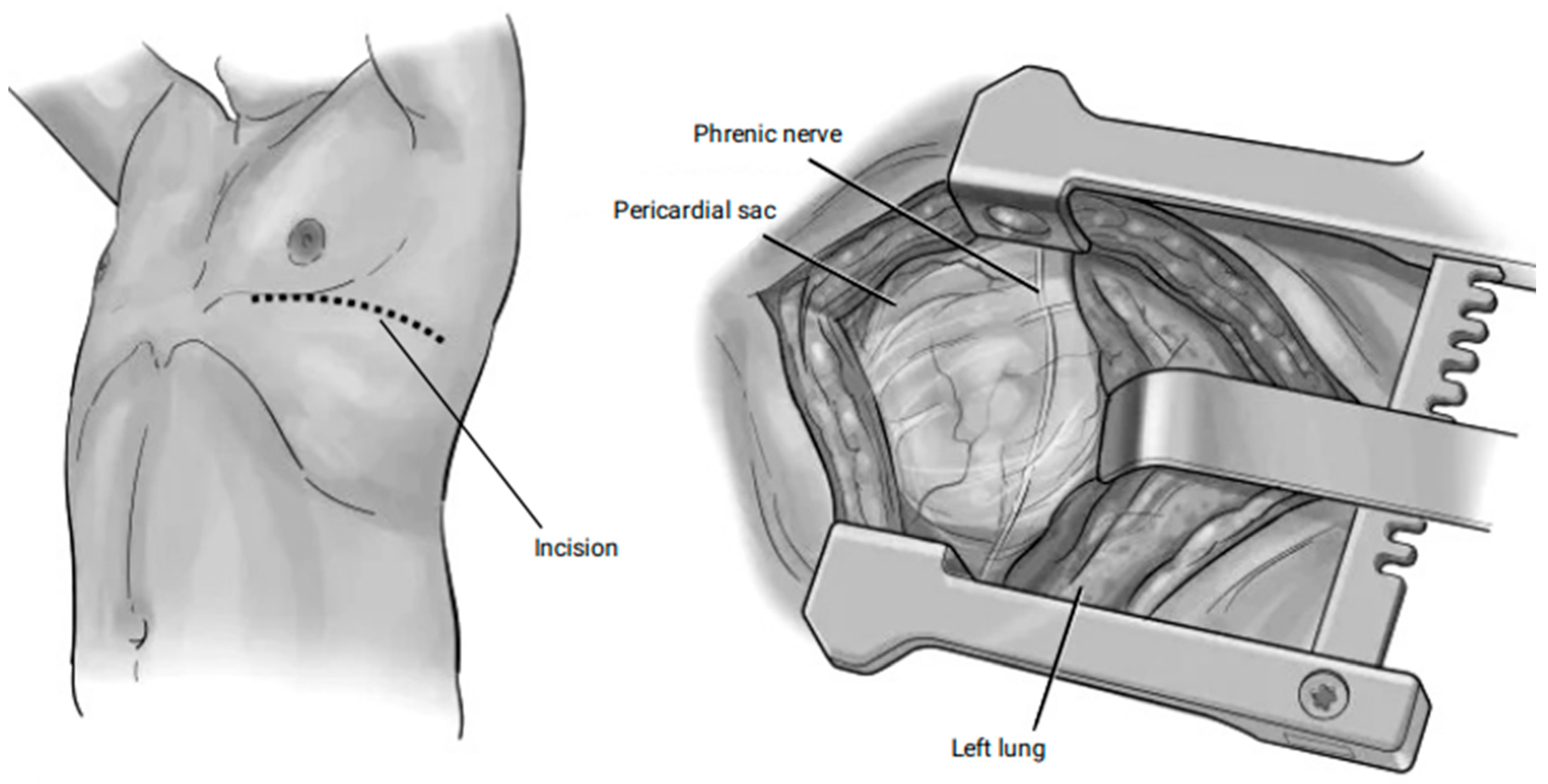 Surgical Management Strategies for Pericardial Effusion—A Systematic Review