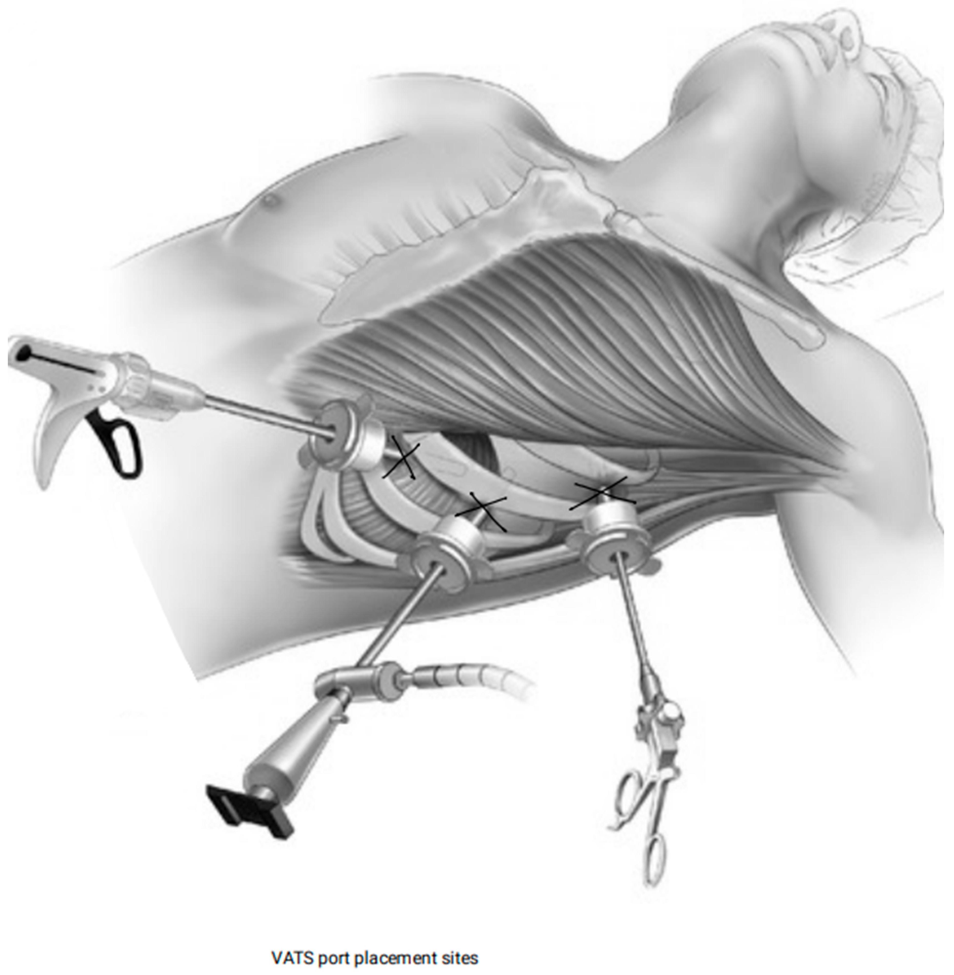 Surgical Management Strategies for Pericardial Effusion—A Systematic Review