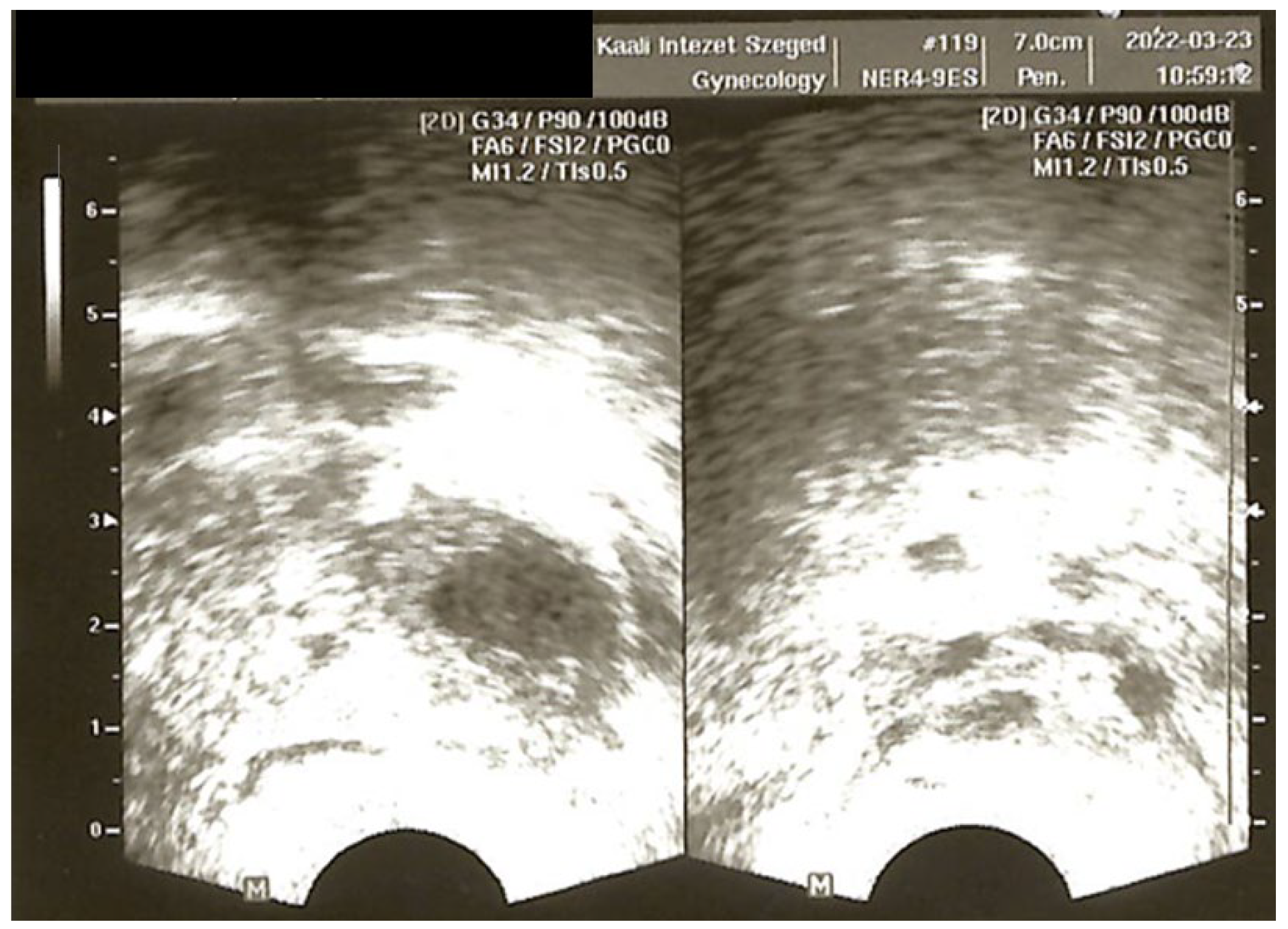 The Double-Edged Nature of the Gonadotropin-Releasing Hormone Agonist ...