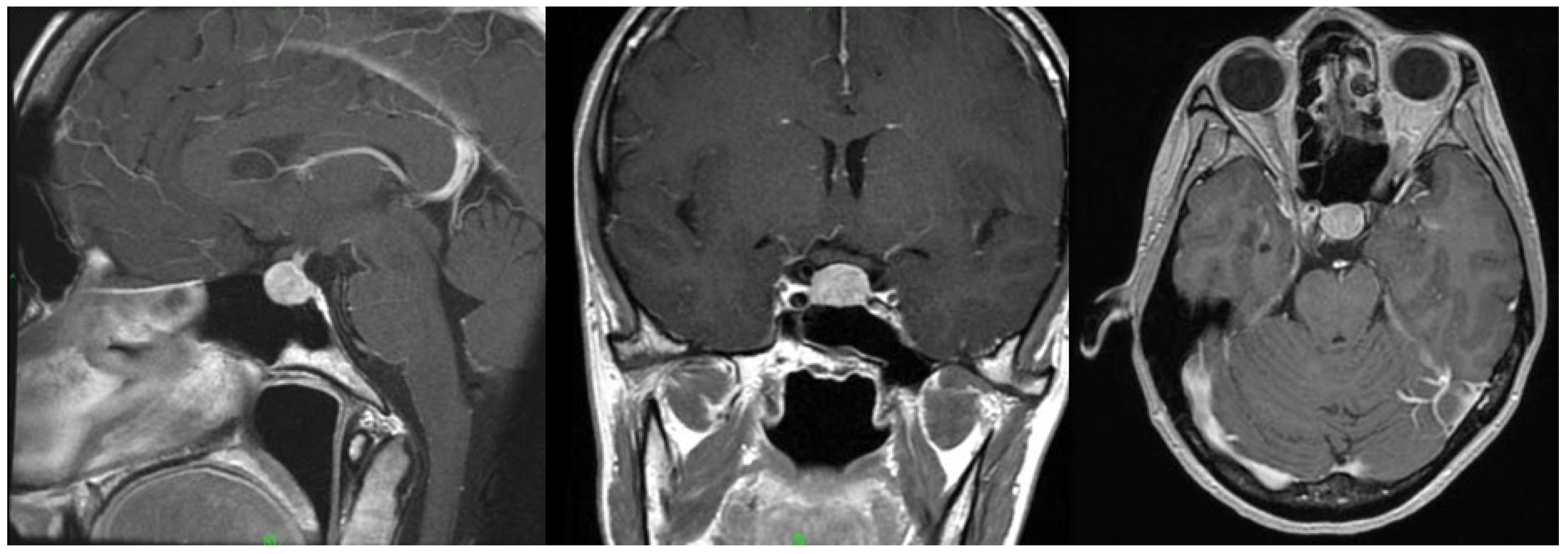 The Double-Edged Nature of the Gonadotropin-Releasing Hormone Agonist ...