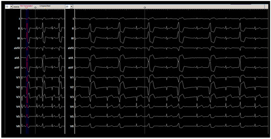Catheter Ablation of Premature Ventricular Contractions from Right ...