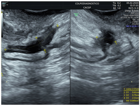 The Effect of Dienogest on Deep Endometriosis Nodules Involving the ...