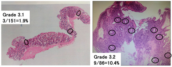 Assessment of Ulcerative Colitis Patients with Elevated Neutrophilic ...