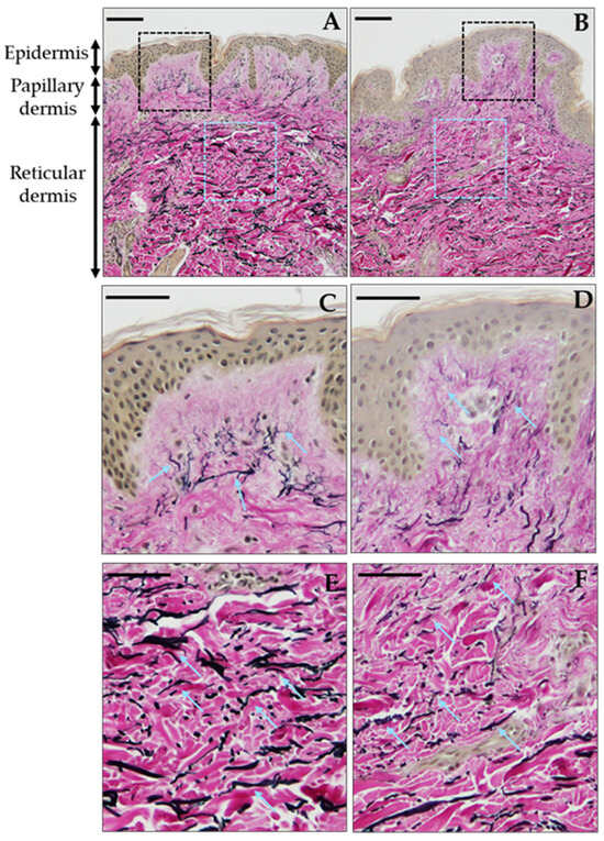 Early Structural Degradation of Dermal Elastic Fibers in Women with ...