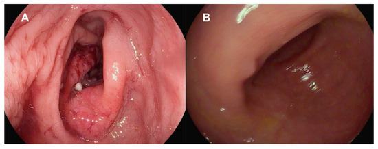Infectious Proctitis Mimicking Advanced Rectal Cancer: A Case Report ...