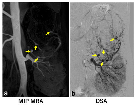 Comparison Between Non-Enhanced Magnetic Resonance Angiography (MRA ...