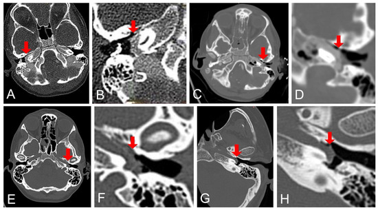 Management of Aberrant Internal Carotid Artery Injury Caused During ...